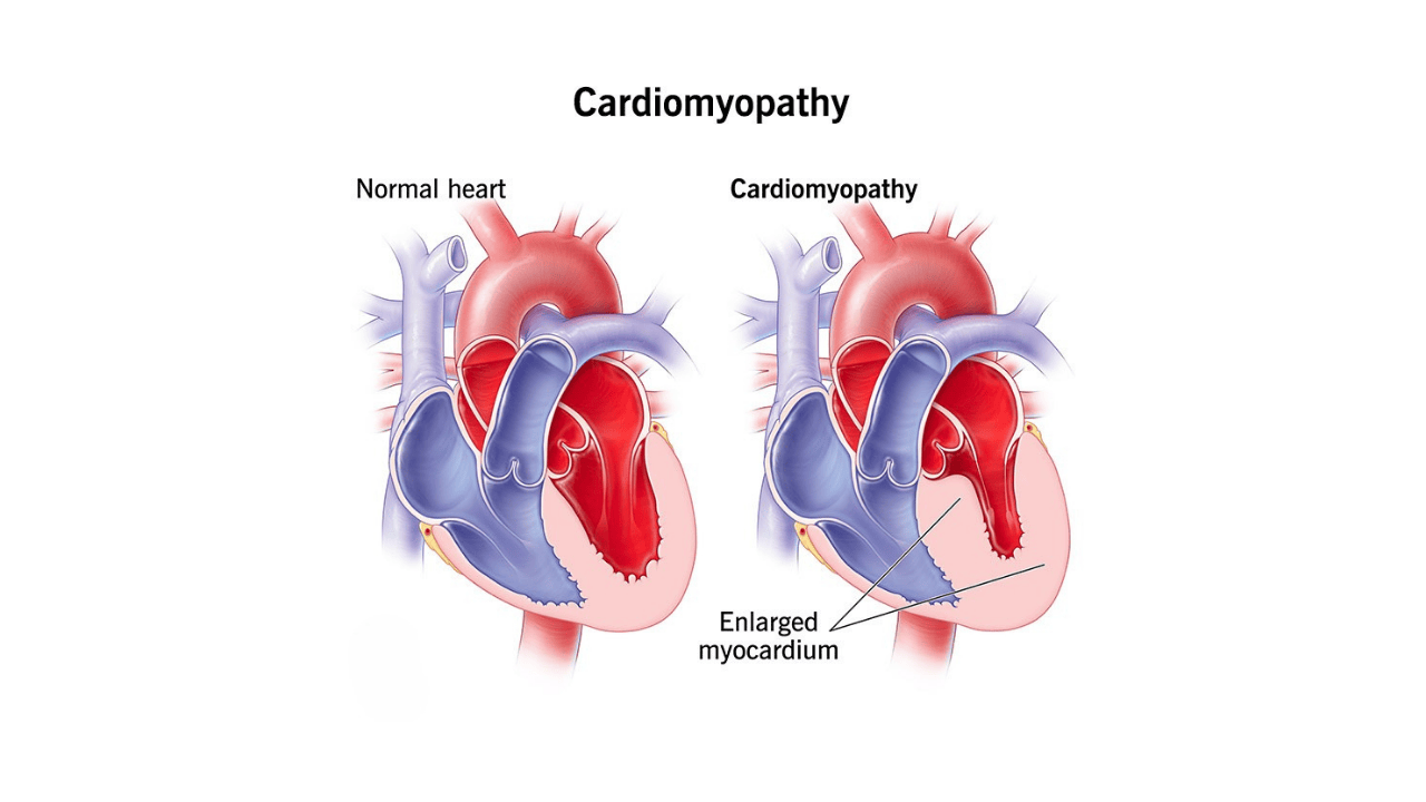 Cardiomyopathy Treatment