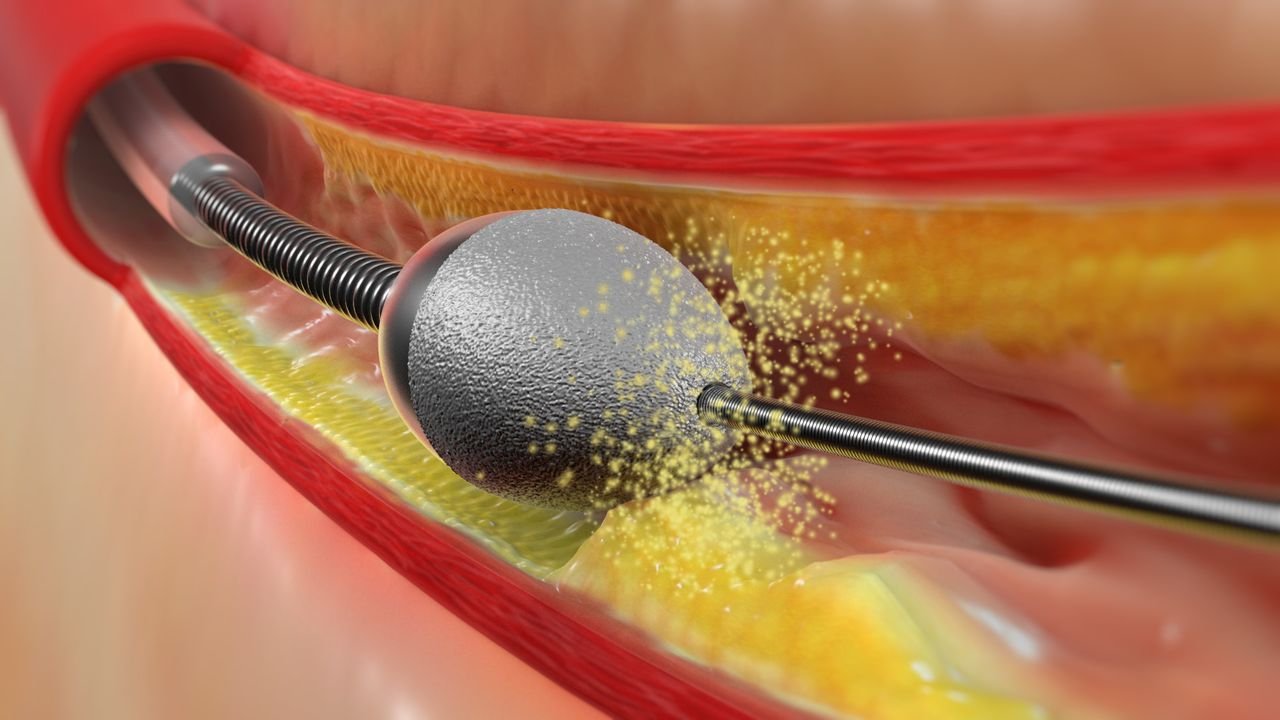 OCT & ROTA Stenting